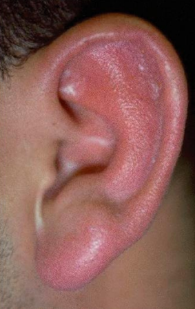 Maladie : symptômes et manifestations - Association Francophone Contre ...